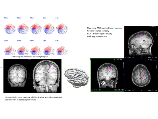 Meg Scan Magnetoencephalography (MEG) Scanner Home
